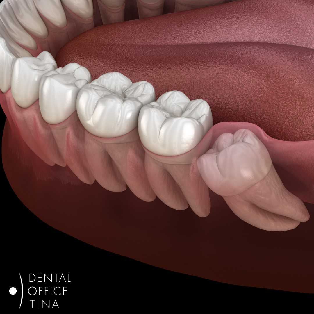 Vađenje umnjaka – riješite se umnjaka, ali i boli • Dental Office Tina