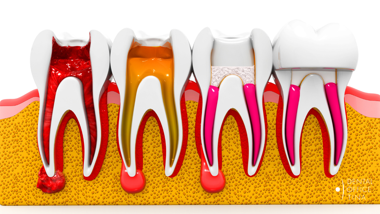 Strojna endodoncija: Suvremeno liječenje zubnih kanala • Dental Office Tina
