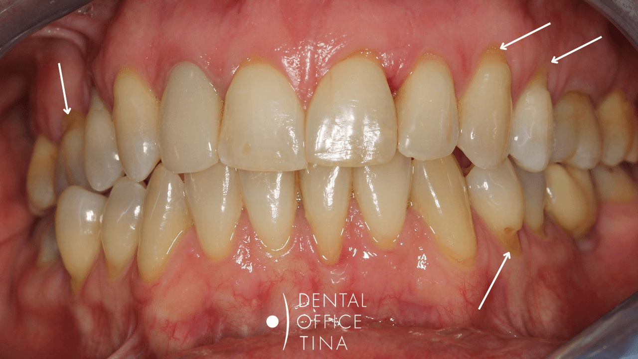 Ogoljeni zubni vratovi i preosjetljivost zuba • Dental Office Tina